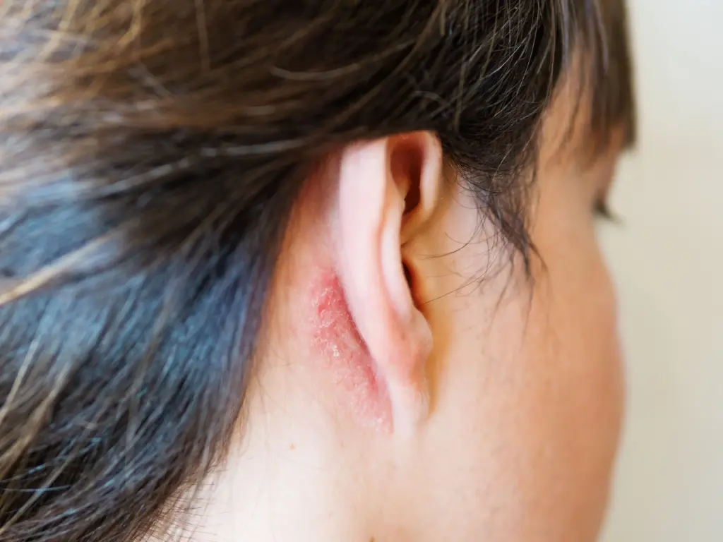 Psoriasis in the ears - Xemsis